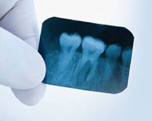 Dental Medical Code For Wisdom Tooth Extraction